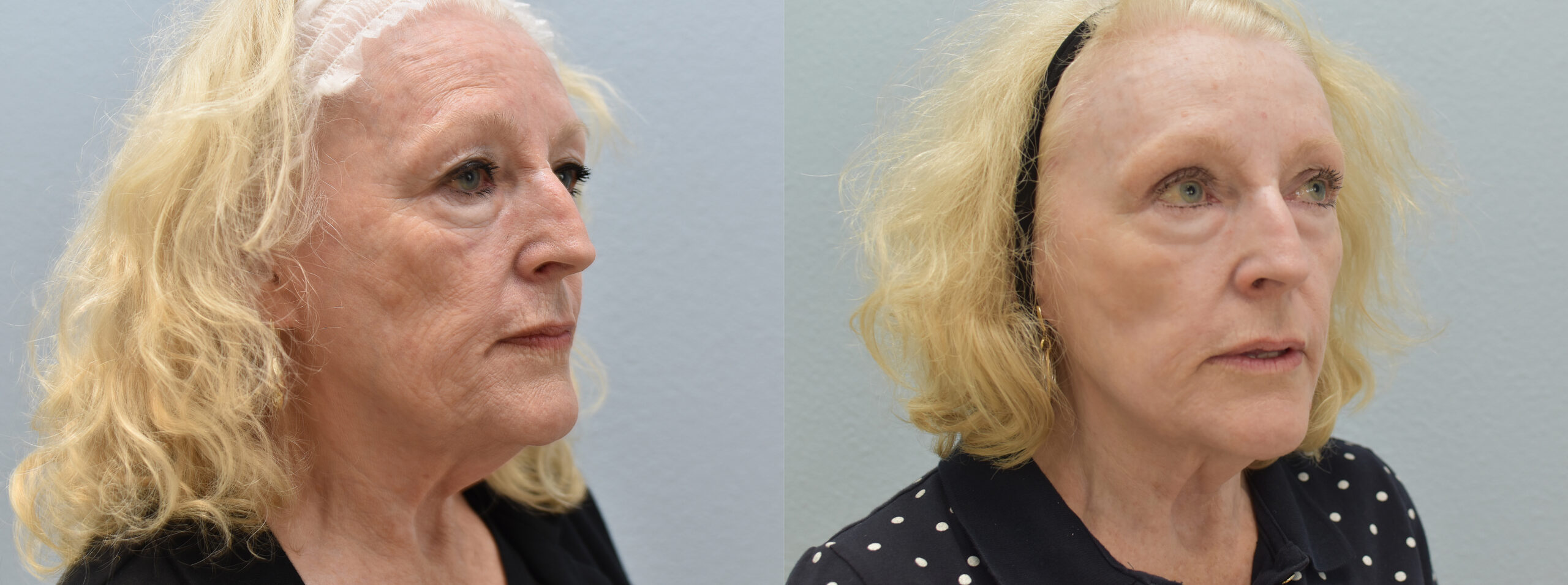 Patient 47149656 | Laser Resurfacing Before & After Photos in Gresham, OR